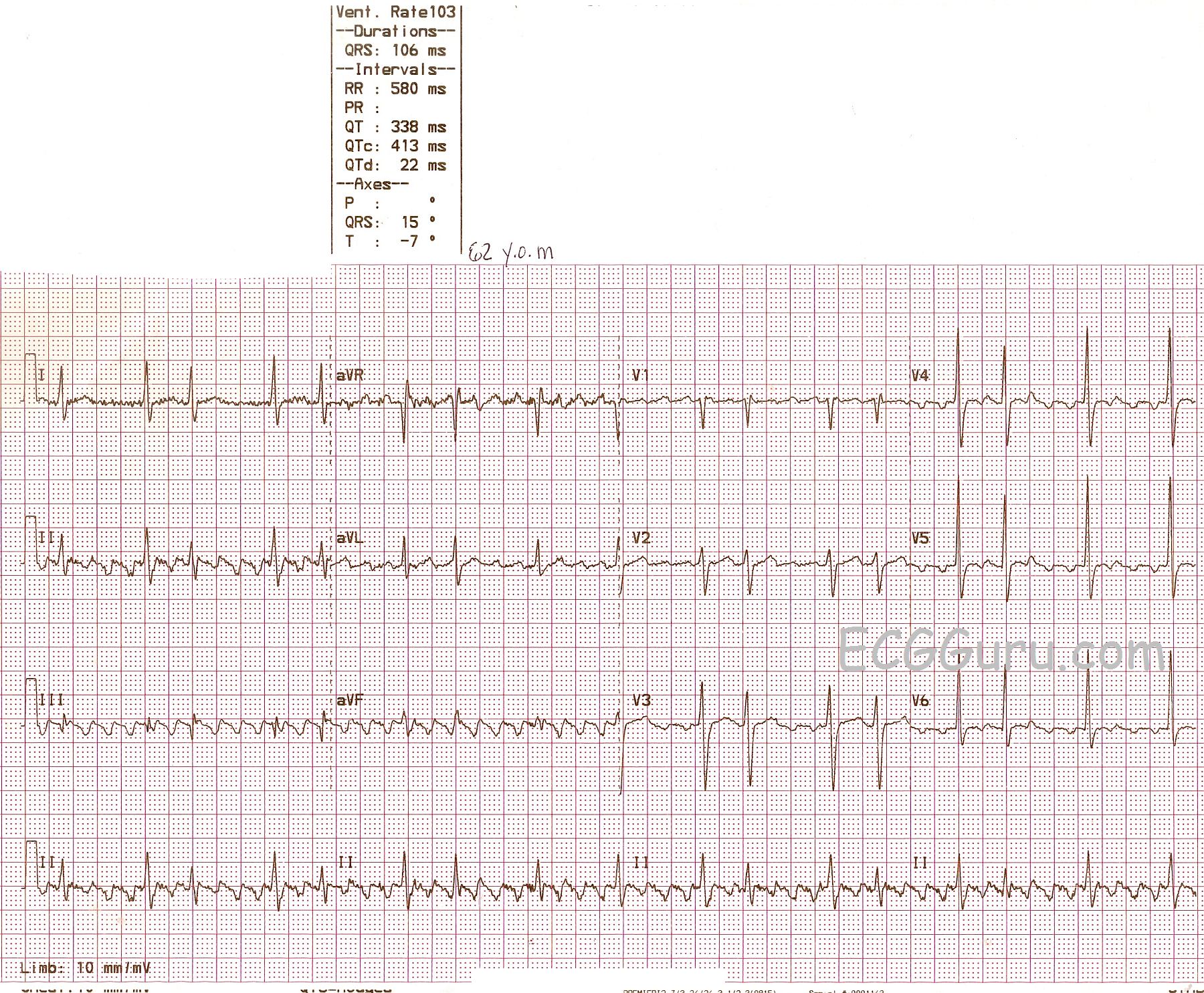 Atrial Flutter With Variable Conduction | ECG Guru - Instructor Resources